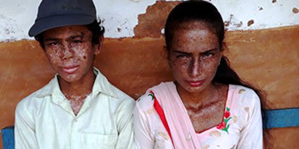 2 of 3 children diagnosed with skin cancer, family in search of ...