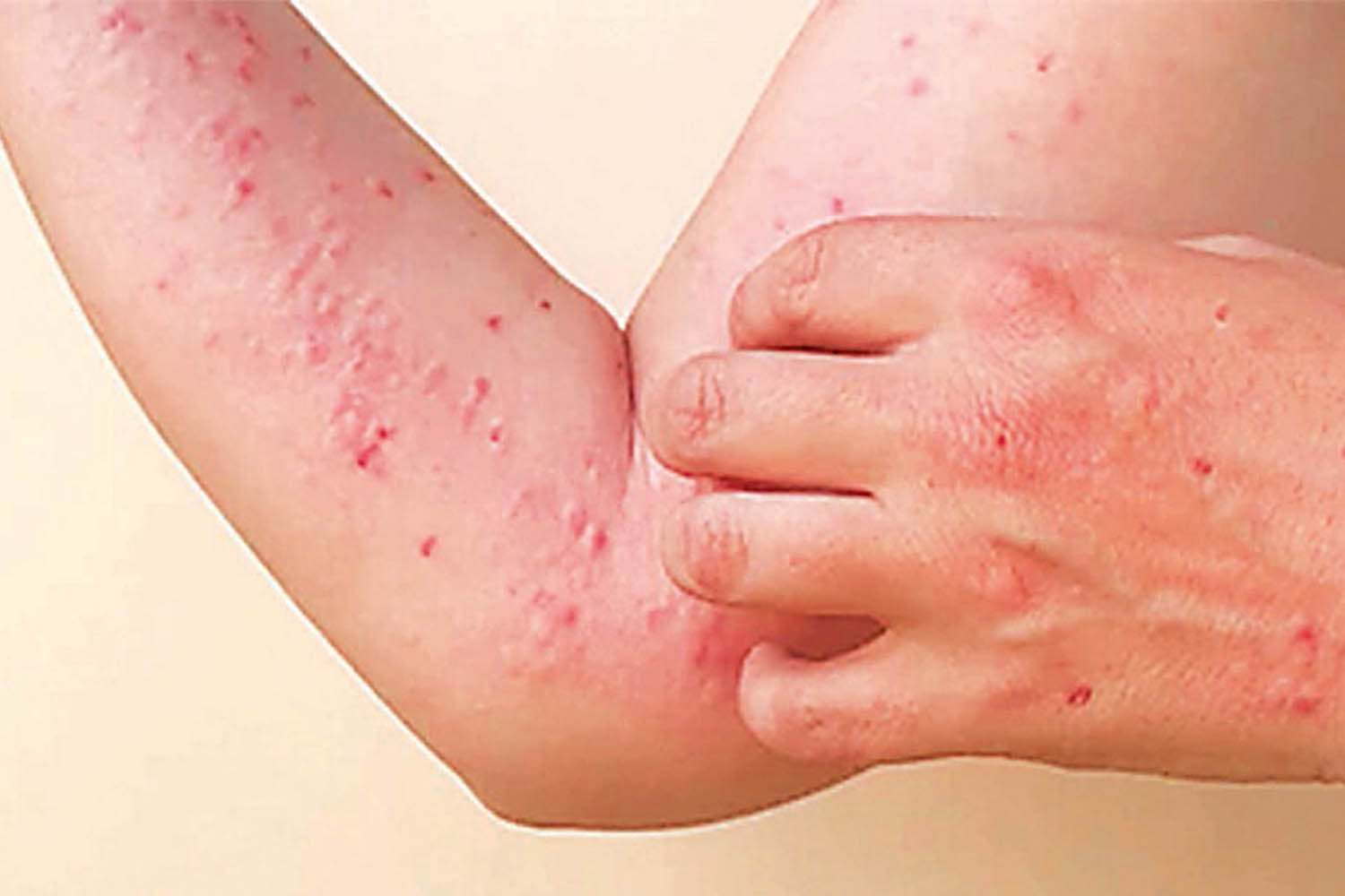 Nepal on high alert after WHO declares global mpox emergency